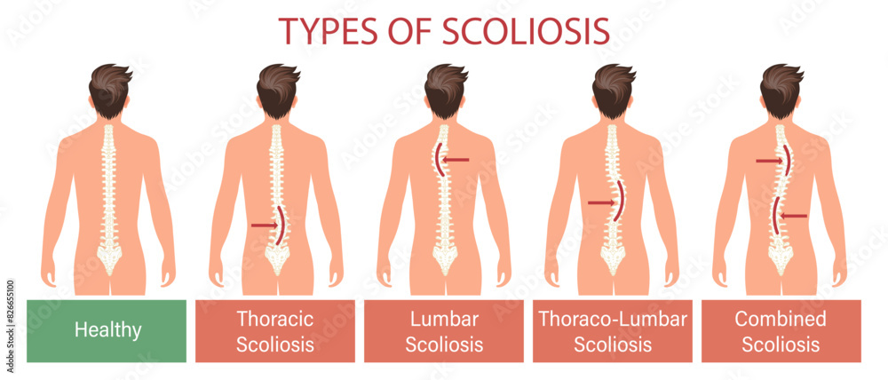 Types of scoliosis, spinal disease. Infographics banner with human ...