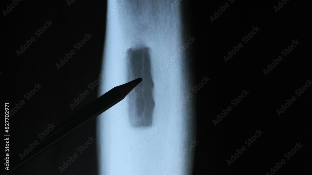 Doctor examining bone tumor. X-ray and MRI, MRT, CT with marked ...