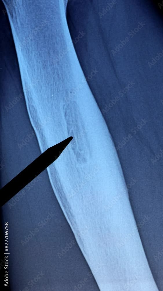 Vertical footage of a doctor examining bone tumor. X-ray and MRI, MRT ...