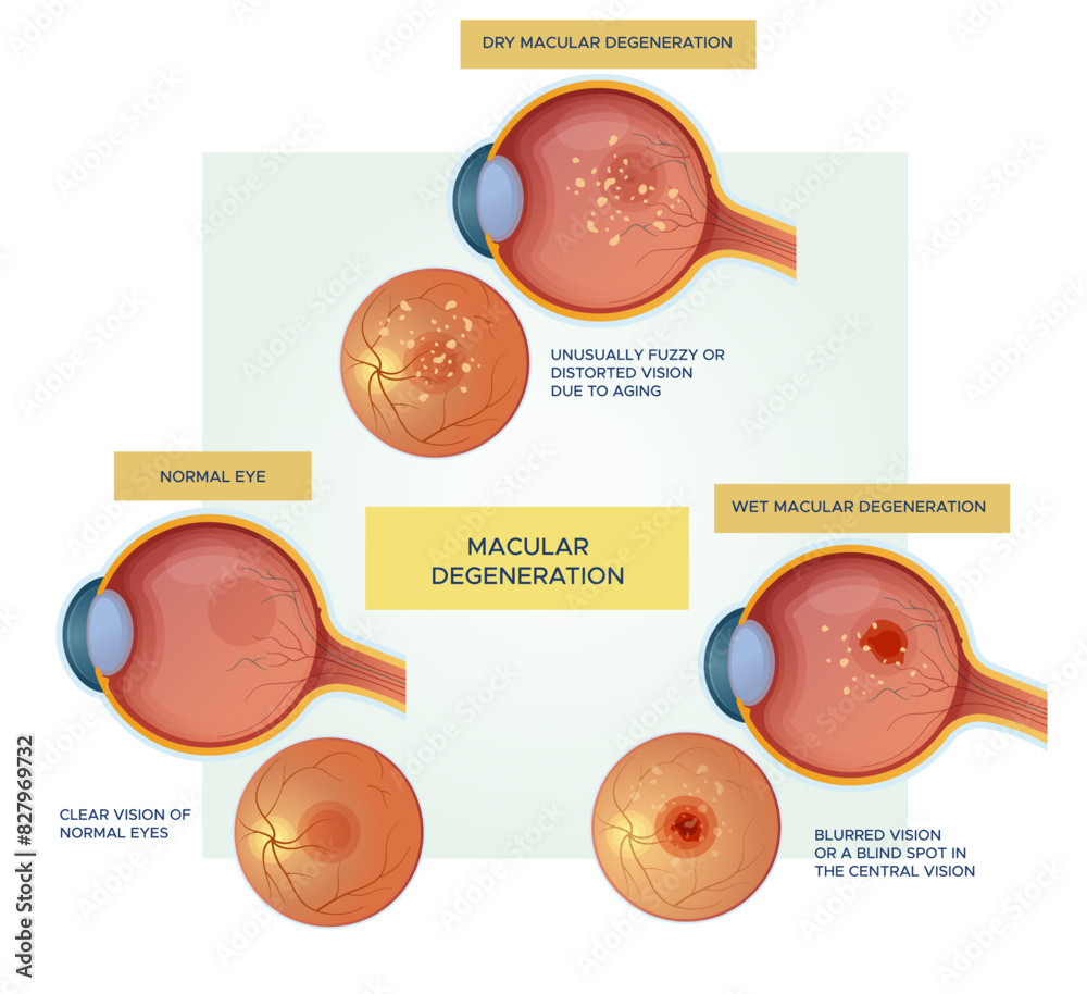Normal Eyes vs Dry / Wet Macular Degeneration - Stock Illustration ...
