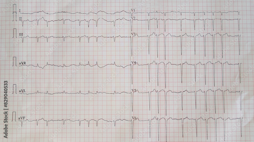 ECG showing Atrial Fibrillation Stock Photo | Adobe Stock