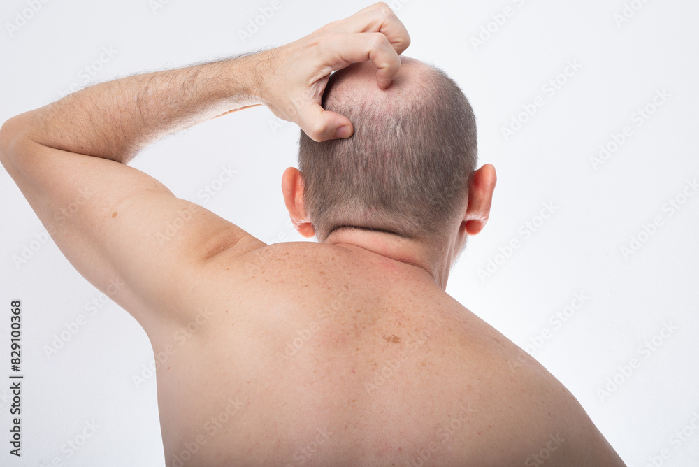 Man, shirtless, scratching his head. Allergic reaction. Skin disease ...