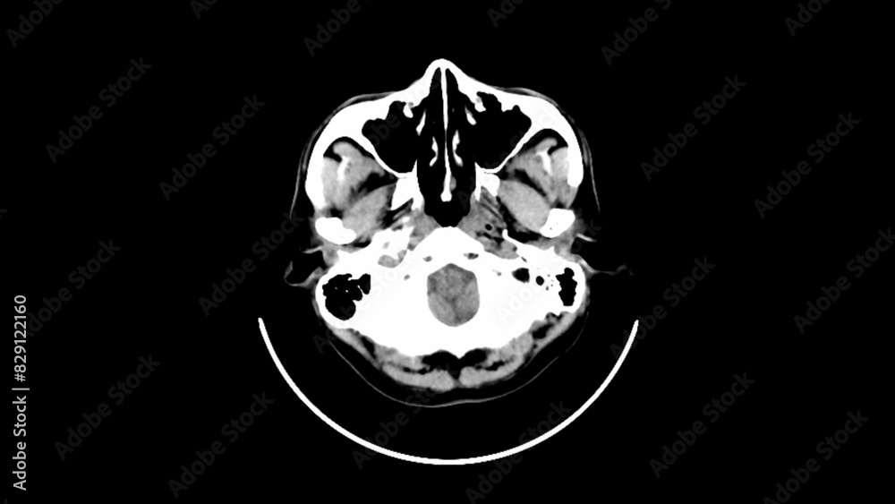 normal head ct scan brain window Stock Illustration | Adobe Stock