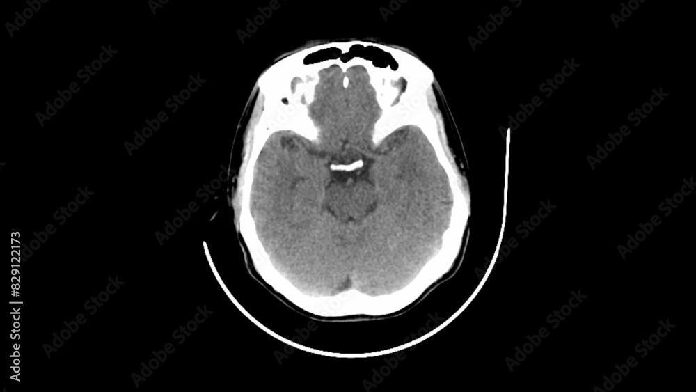 normal head ct scan brain window Stock Illustration | Adobe Stock normal head ct scan brain window Stock Illustration | Adobe Stock