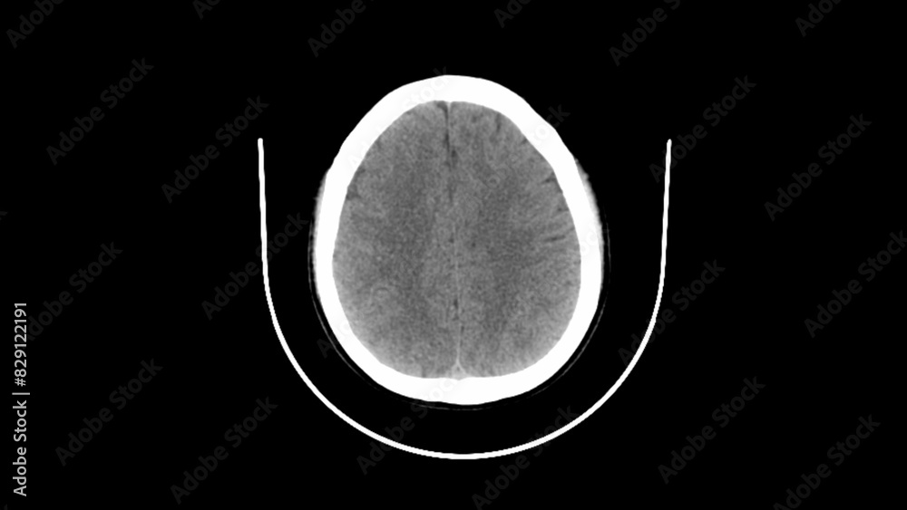 normal head ct scan brain window Stock Illustration | Adobe Stock
