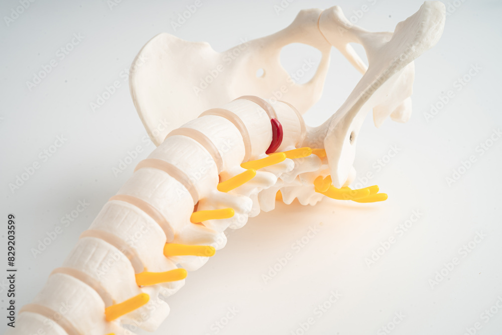 Lumbar spine displaced herniated disc fragment, spinal nerve and bone ...