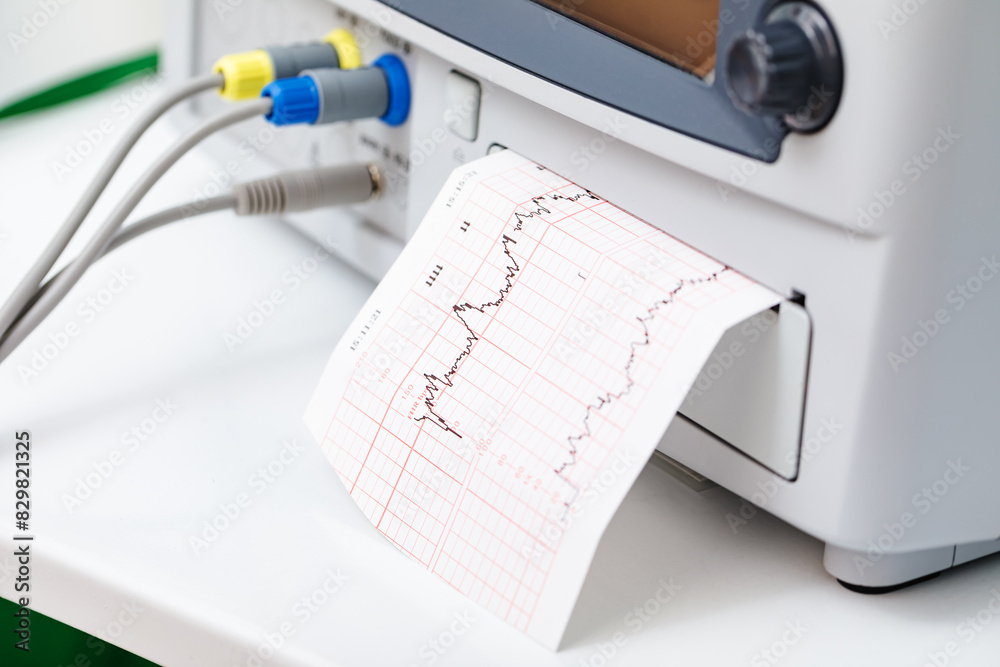 Cardiotocography CTG Fetal Heartbeat Monitoring Printout Stock Photo | Adobe Stock