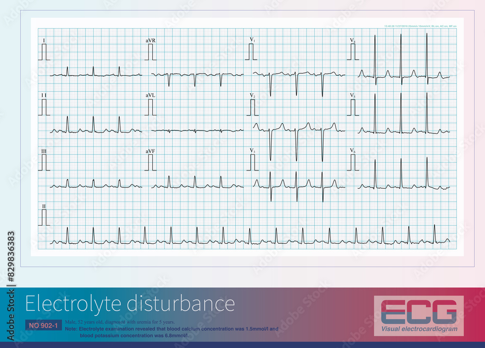 The presence of ST-segment prolongation and T wave symmetry and high ...
