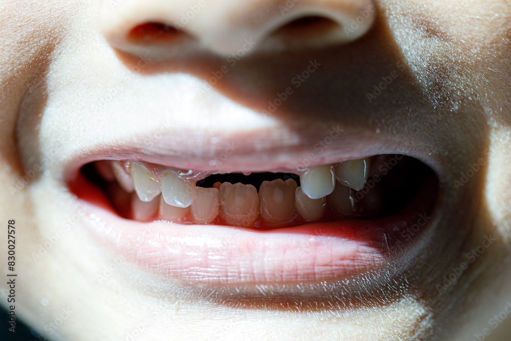 Close up image of the mouth of a little boy who just lost her two front ...