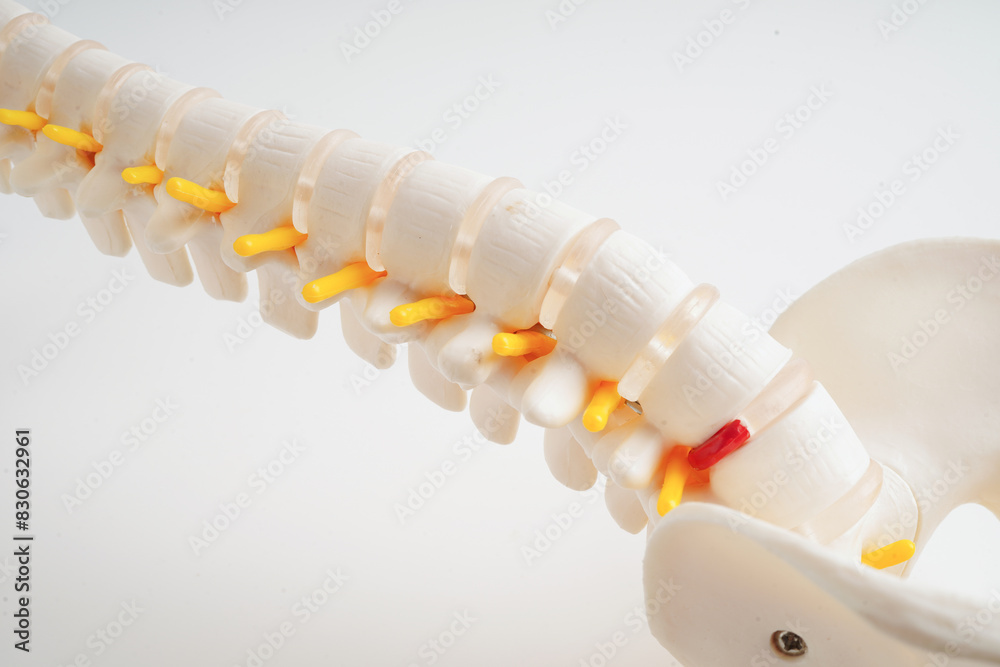 Spinal nerve and bone, Lumbar spine displaced herniated disc fragment ...
