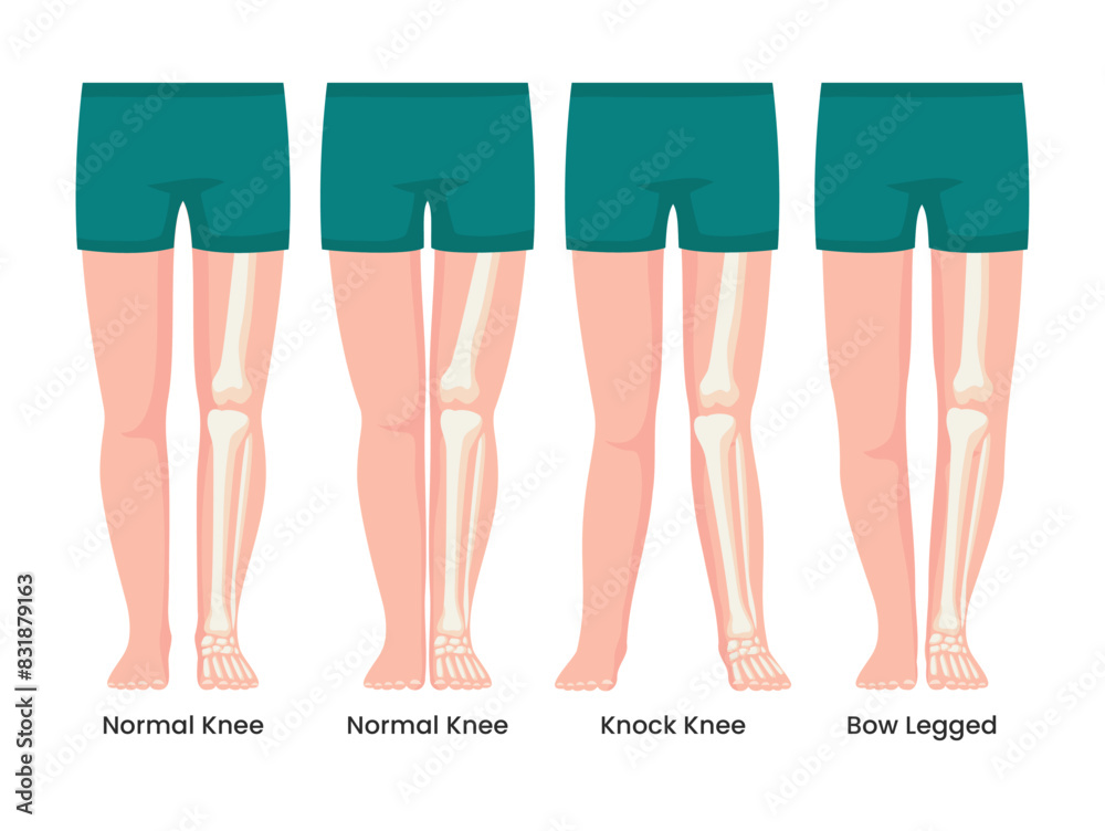 Set different types of Shapes of the legs. Normal and curved legs ...
