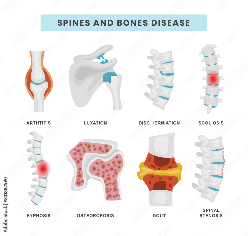 Set of spine and bone disease collection with arthritist, luxation ...