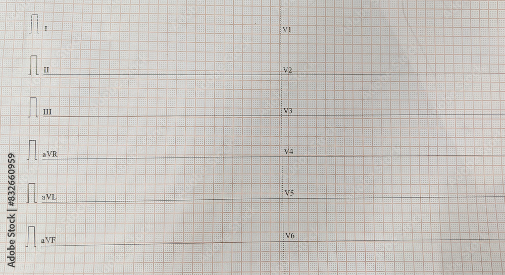 12 lead ECG showing Flat line which represents the stoppage of cardiac ...