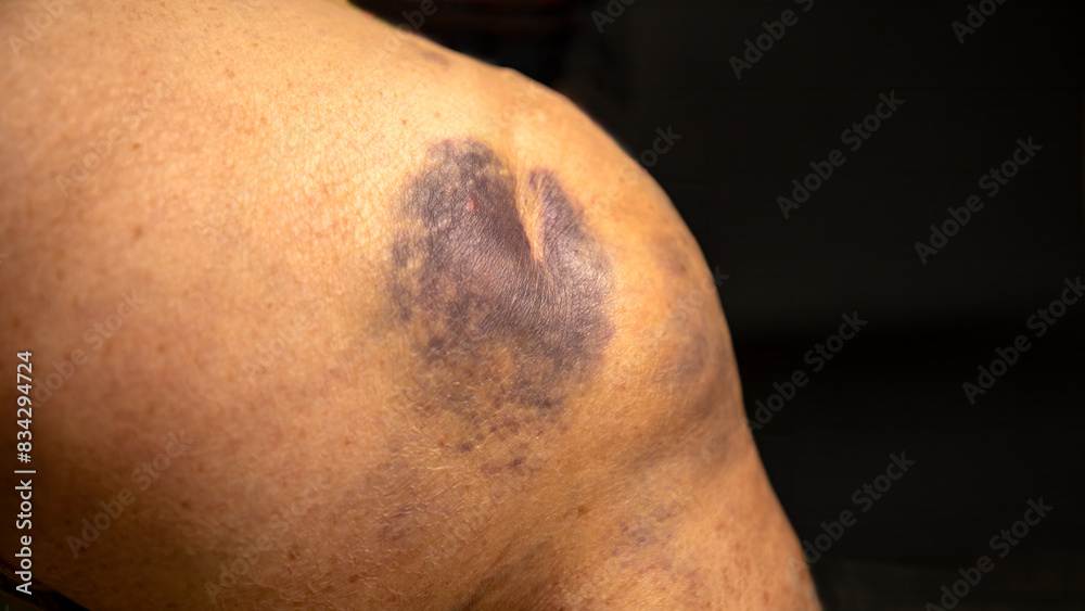 Detailed close-up of severe bruise on senior knee, showing extent of ...