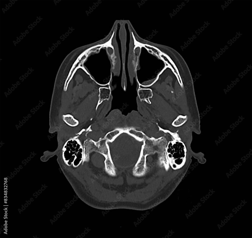 High-Resolution Brain CT Scan with Clear Cerebral Anatomy and Sinuses ...