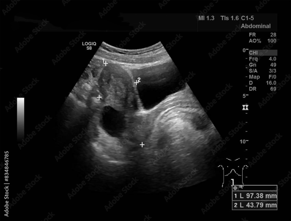 Abdominal Ultrasound Image with Detailed Organ Structures, Perfect for ...