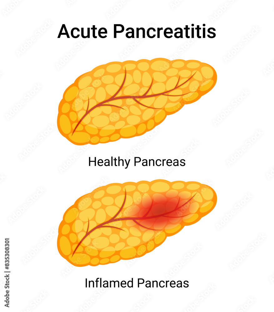 Symptoms of Acute Pancreatitis healthy and inflamed pancreas Stock ...