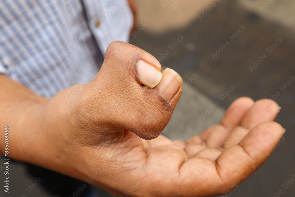 A Close up picture of an abnormal human hand known as Congenital hand ...