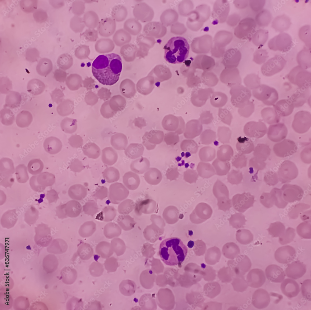 Bone marrow study (BMS). Chronic hyper eosinophilic syndrome. Hypo and ...
