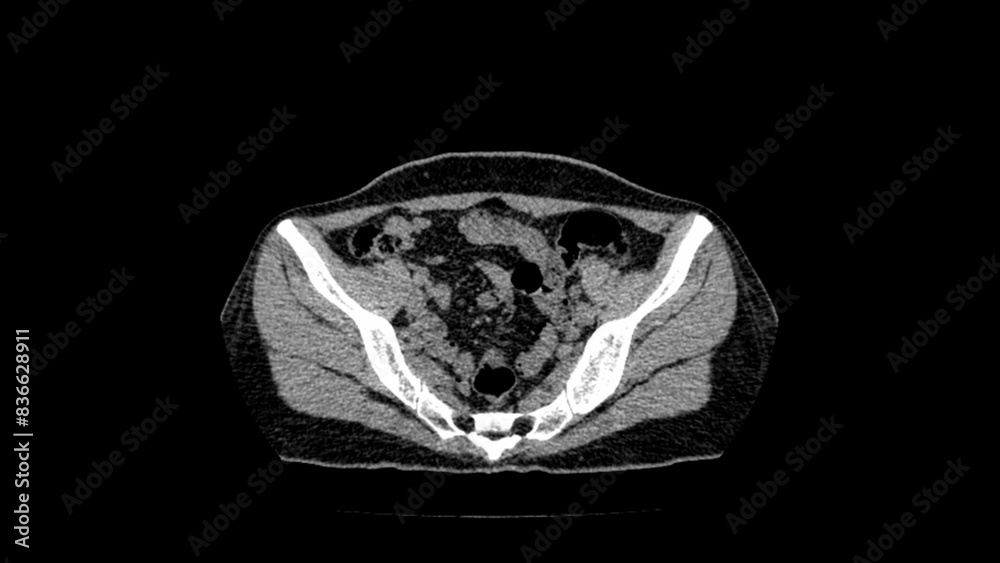 normal abdomen CT scan Stock Illustration | Adobe Stock
