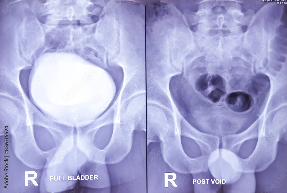 X-Ray film of RGU and MCU (Retrograde urethrogram and micturating ... X-Ray film of RGU and MCU (Retrograde urethrogram and micturating ...