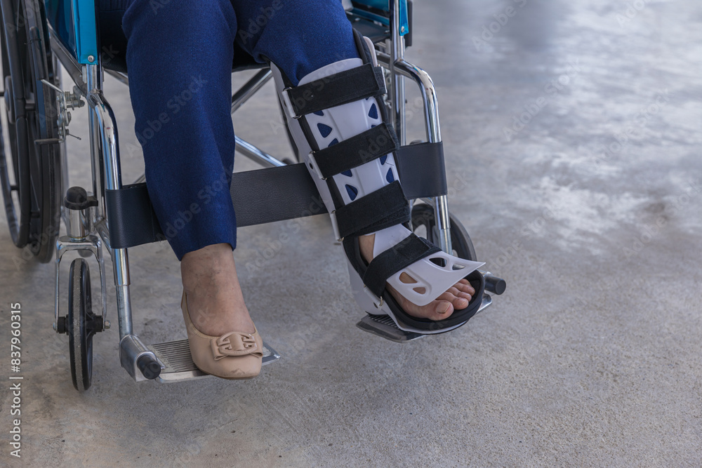 Foto de Foot orthosis concept. woman leg with adjustable ankle foot ...