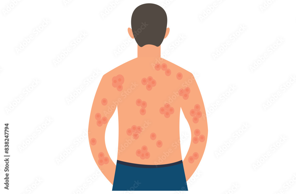 Poster Autoimmune progesterone dermatitis,urticaria,Bullous pemphigoid ...