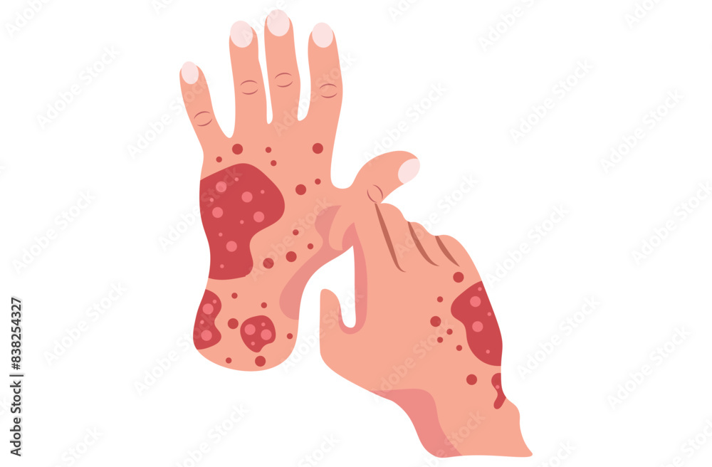 Autoimmune progesterone dermatitis,urticaria,Bullous pemphigoid ...