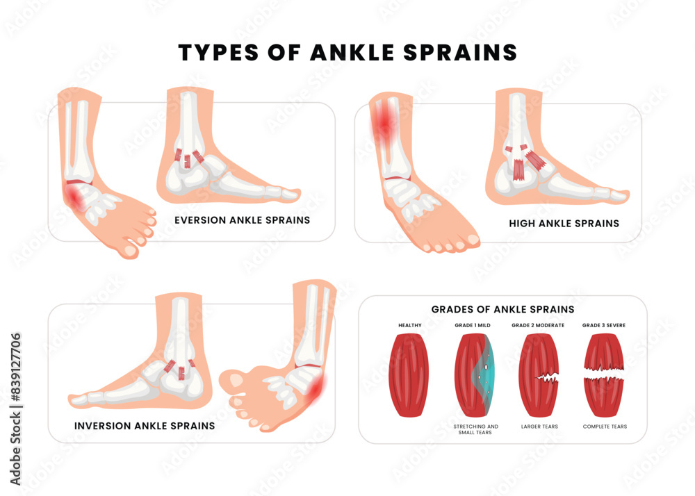 Set of different types of ankle sprains banner, foot medical injury ...