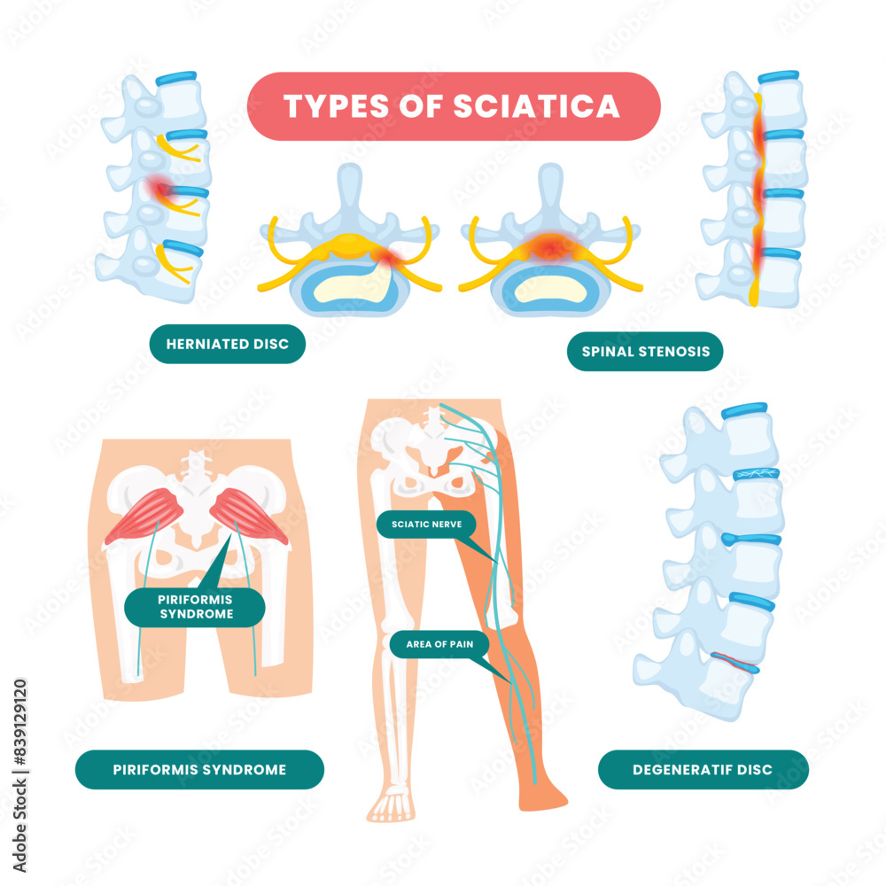 Different types of sciatica poster scheme, medical banner, Sciatica as ... Different types of sciatica poster scheme, medical banner, Sciatica as ...
