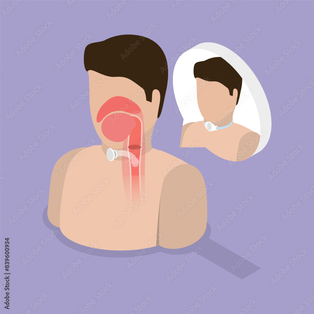 3D Isometric Flat Vector Illustration of Tracheostomy, Tracheal Surgery ...