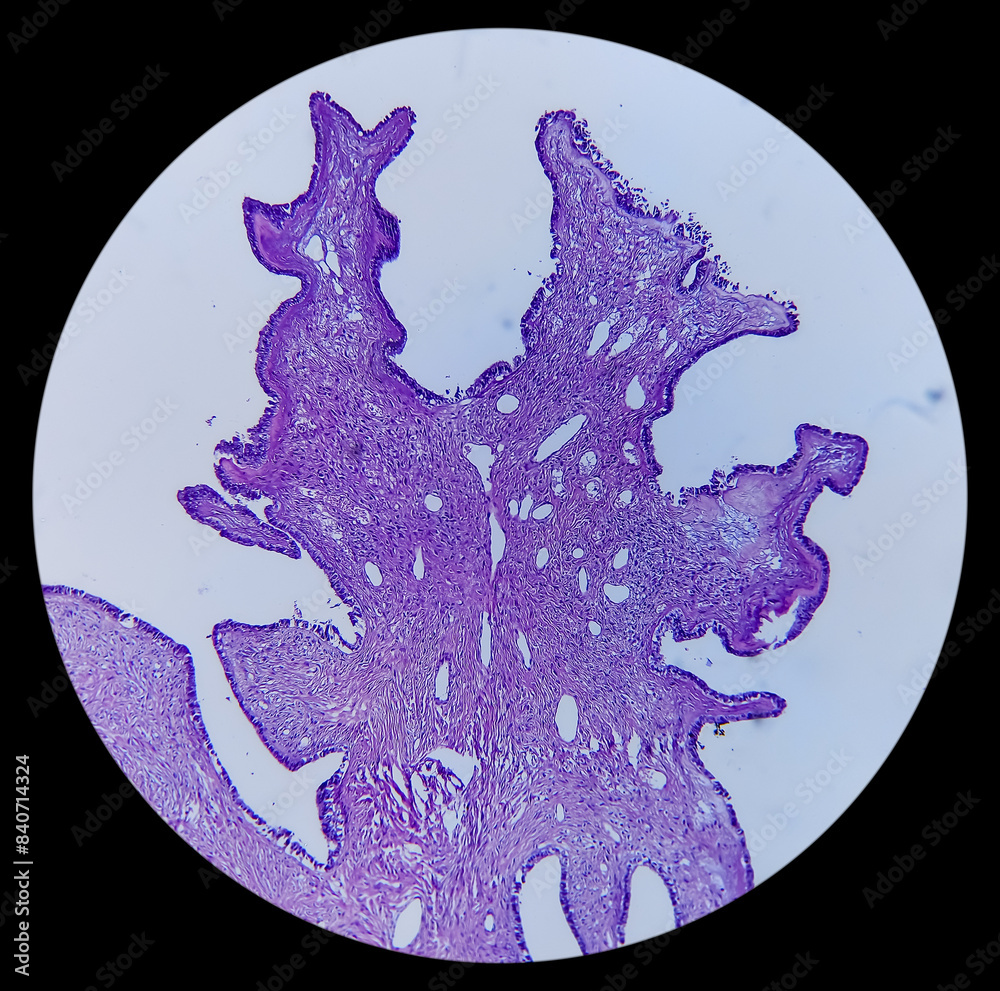 Microscopic image of Papillary borderline serous tumor of the ovary ...