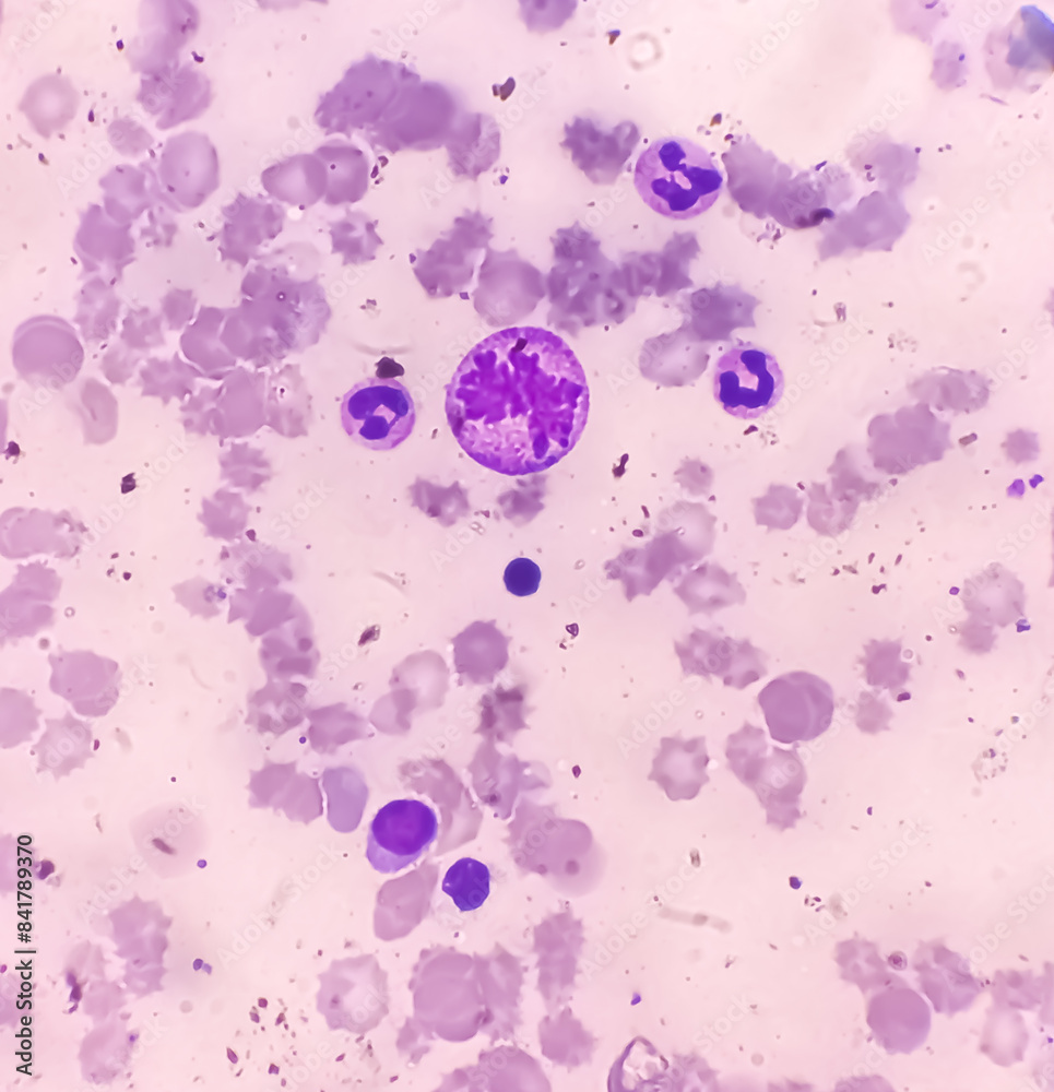 Bone marrow study (BMD). Amegakariocytic thrombocytopenia with ...