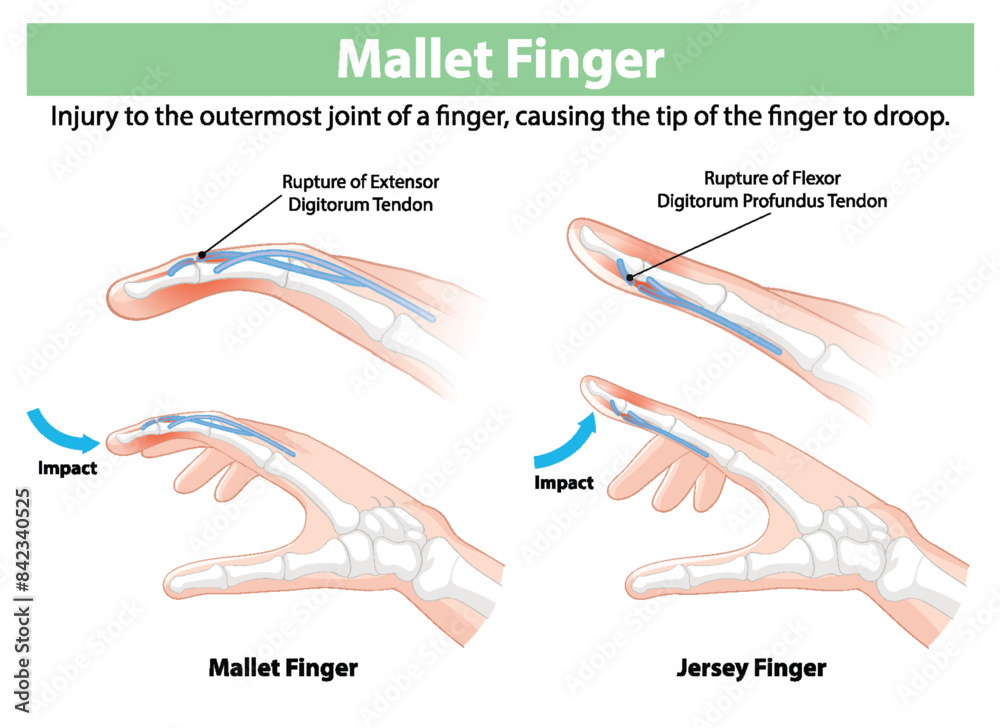 Illustration of finger tendon injuries and their impacts Stock Vector ...