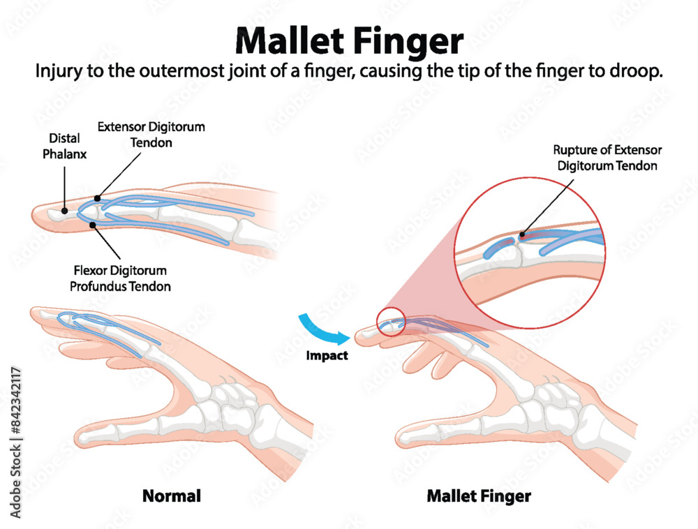 Diagram showing normal and mallet finger conditions Stock Vector ...