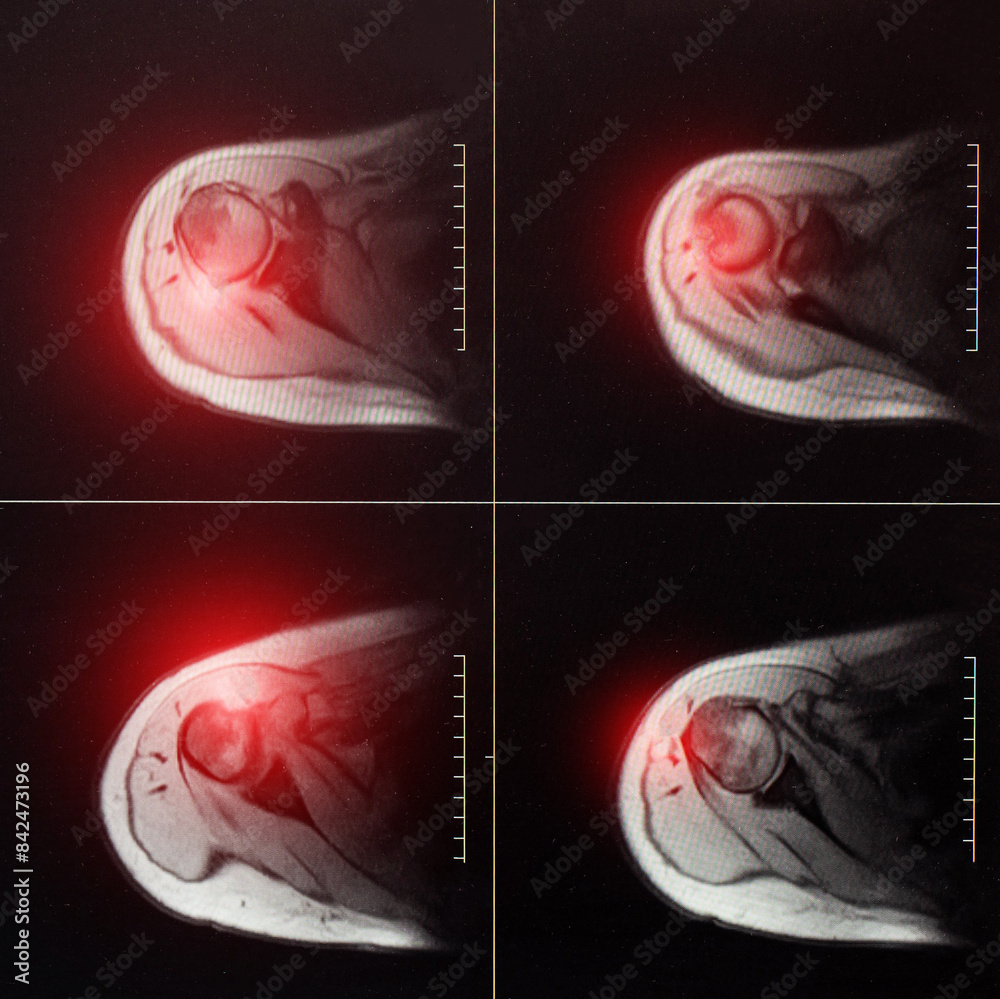 MRI image of the shoulder joint after a fracture and dislocation ...
