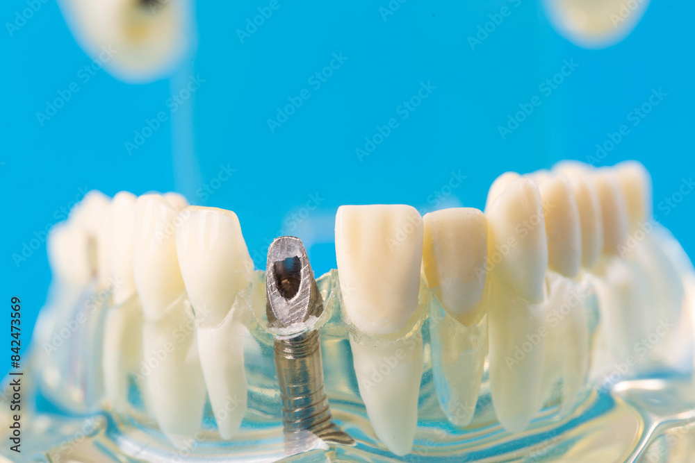 Dental pin in a medical model of the patient's jaw for putting on a ...