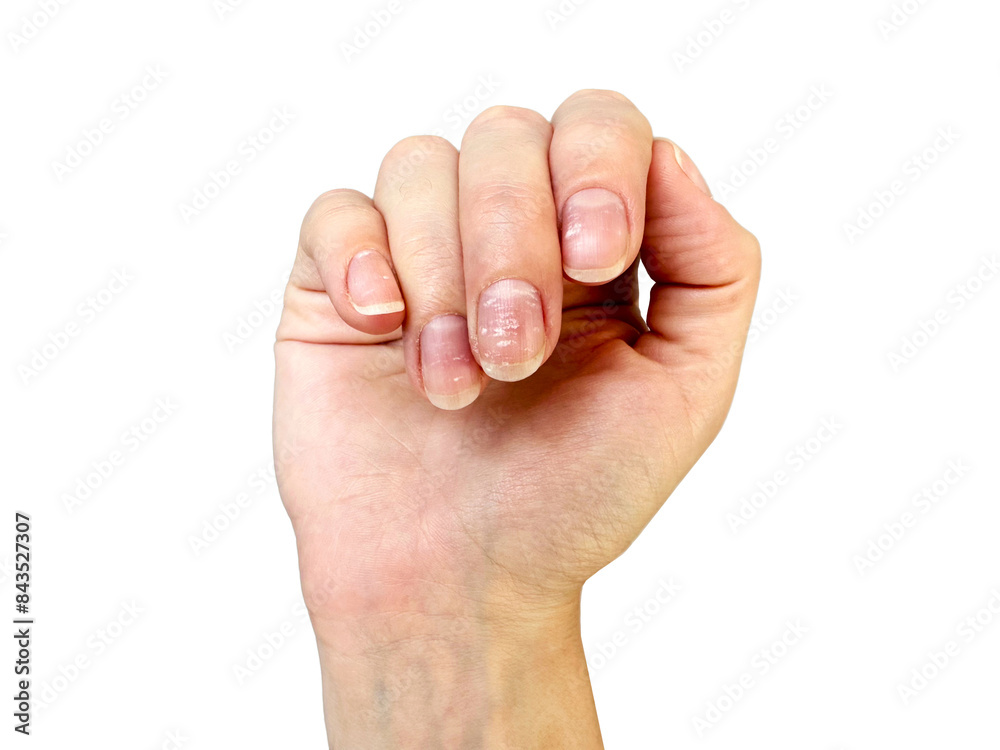 Close up of woman fingernails with deficiency of calcium and zinc ...