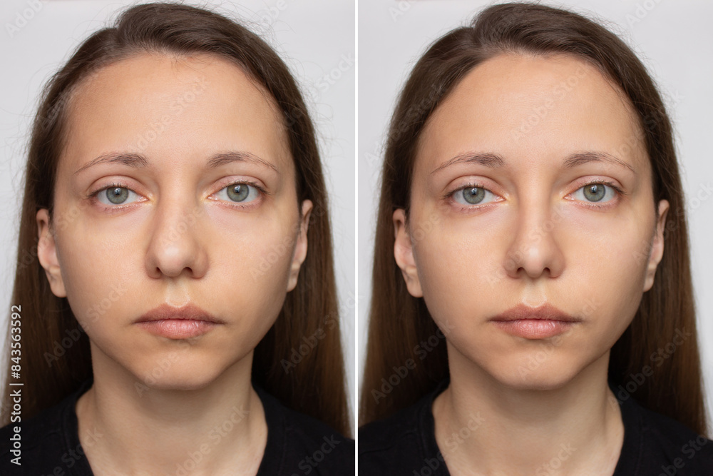 Collage before and after plastic surgery on the nose, isolated on a ...