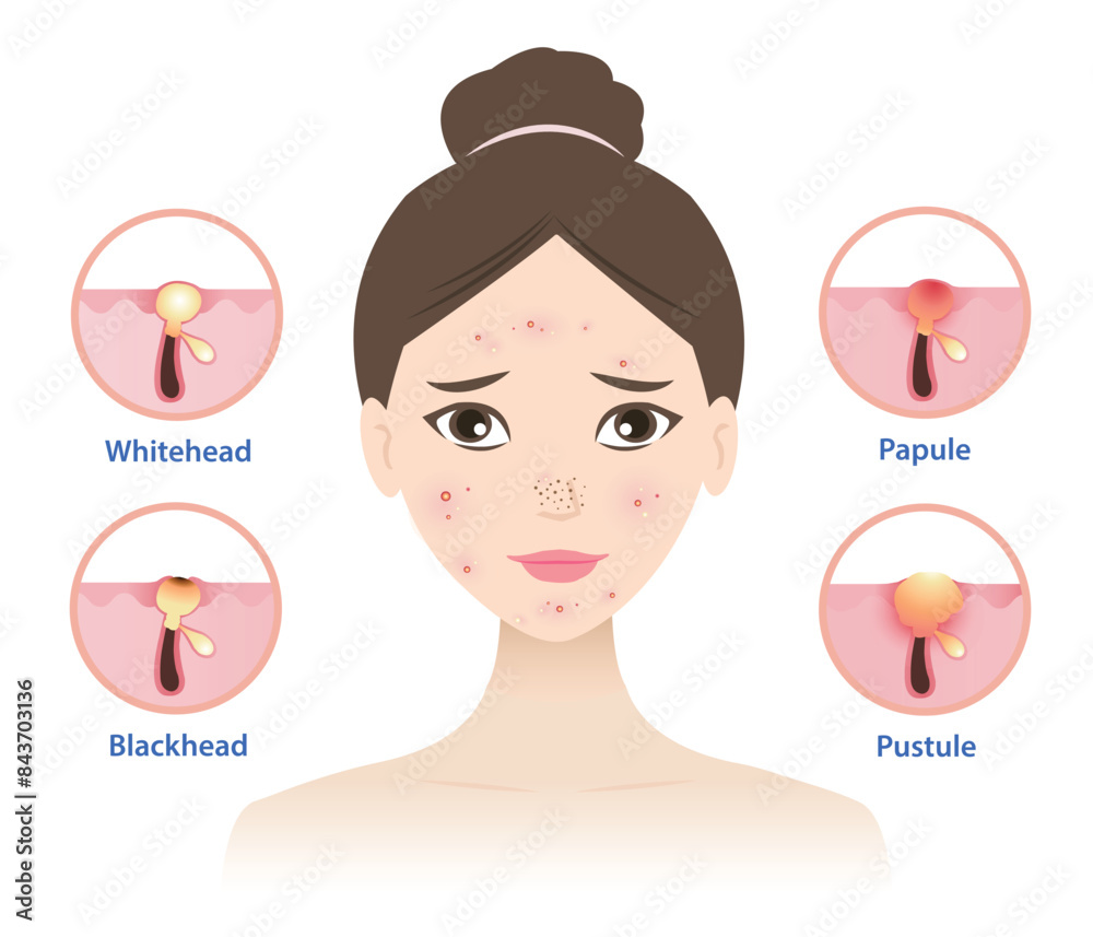 Types of acne on woman face vector illustration isolated on white ...
