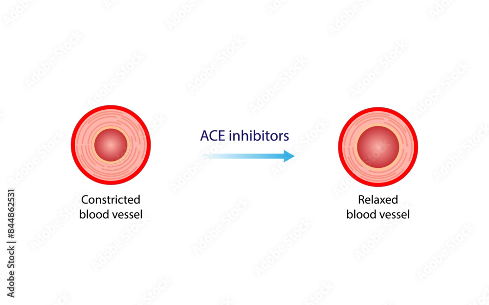 Angiotensin-converting enzyme inhibitors, ACE inhibitors. Renin-Angiotensin-Aldosterone System ...