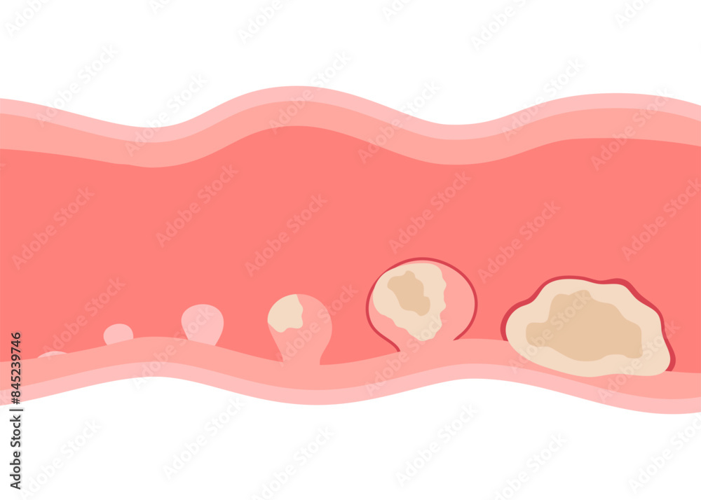 Stage of growth polyp in malignant tumor inside wall of organ. Risk ...