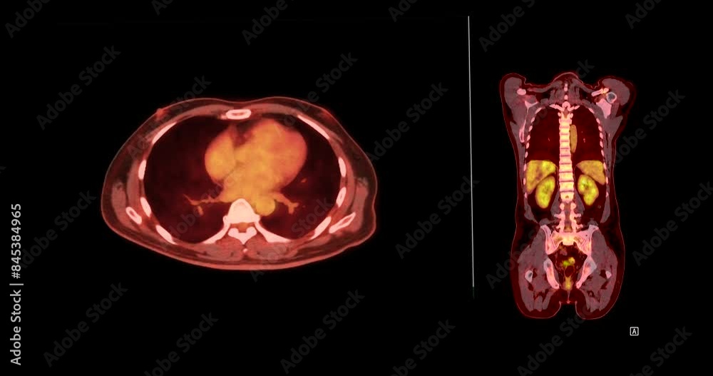 A PET CT scan reveals cholangiocarcinoma with suspected metastatic involvement of the lungs and ...