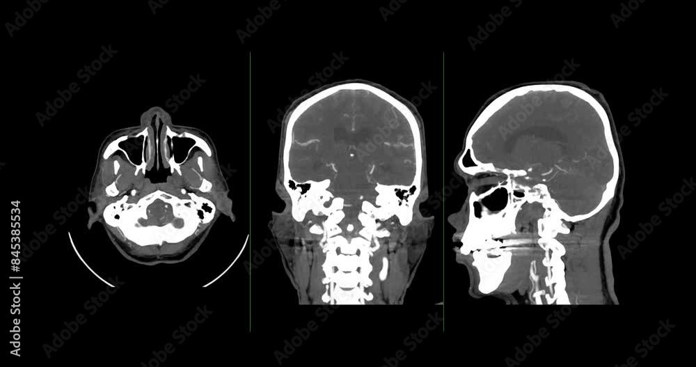 A CT scan of the brain shows a subarachnoid hemorrhage scattered at ...