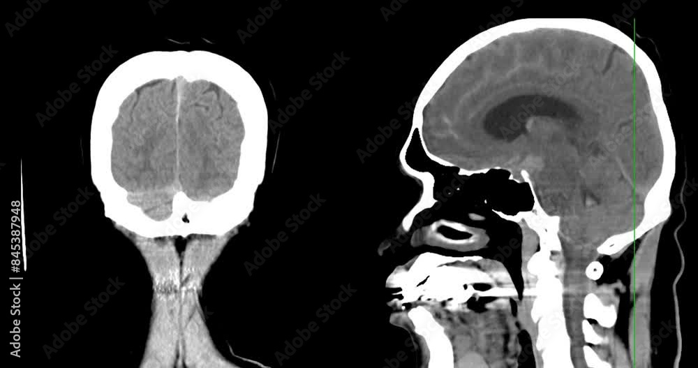 A CT scan of the brain shows a subarachnoid hemorrhage scattered at ...