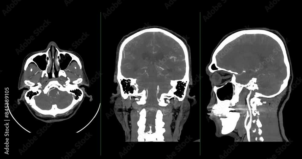A CT scan of the brain shows a subarachnoid hemorrhage scattered at ...
