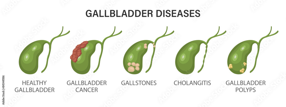 Gallbladder diseases infographics. Gallstone disease, cancer, acute ...