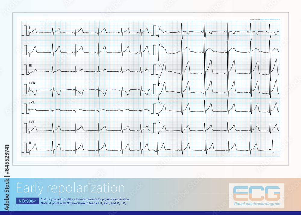Early repolarization is a common benign ECG change that manifests as J ...