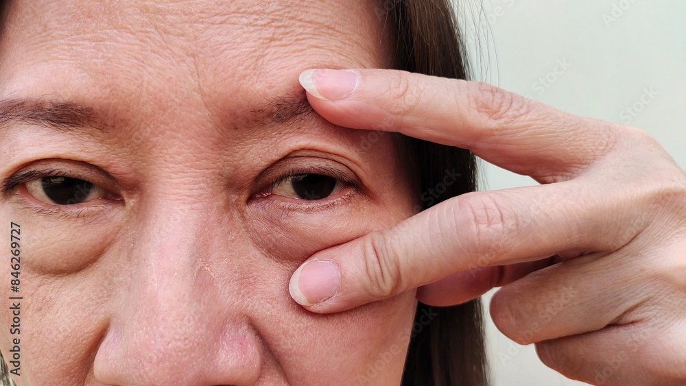portrait with eye problem, Flabbiness and wrinkle, swelling and ptosis ...