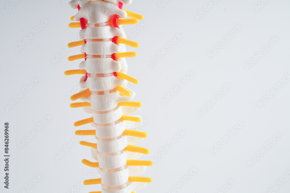 Spinal nerve and bone, Lumbar spine displaced herniated disc fragment ...